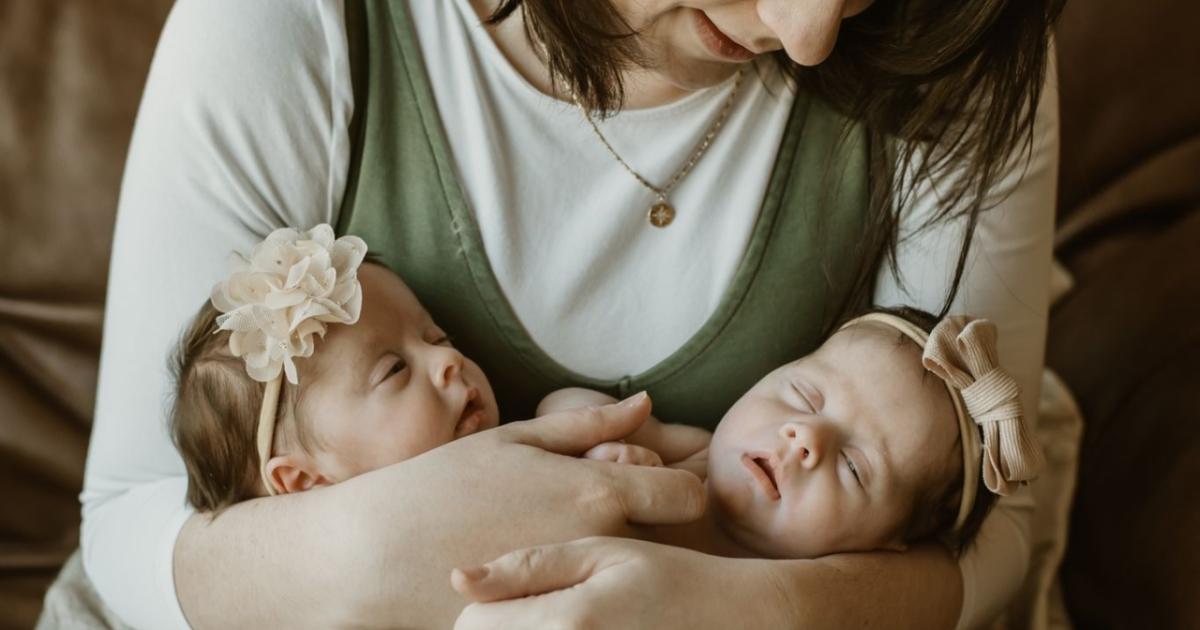 Conjoined twins from Toome are separated successfully - Alpha Newspaper ...